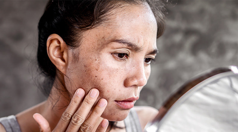 How to Get Rid of Hyperpigmented Scars | NewGel+ | NewGel+