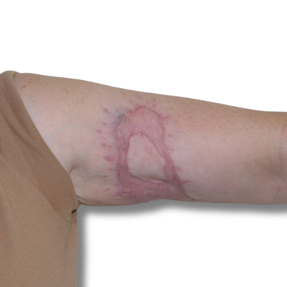 Scar Types and Causes | NewGel+