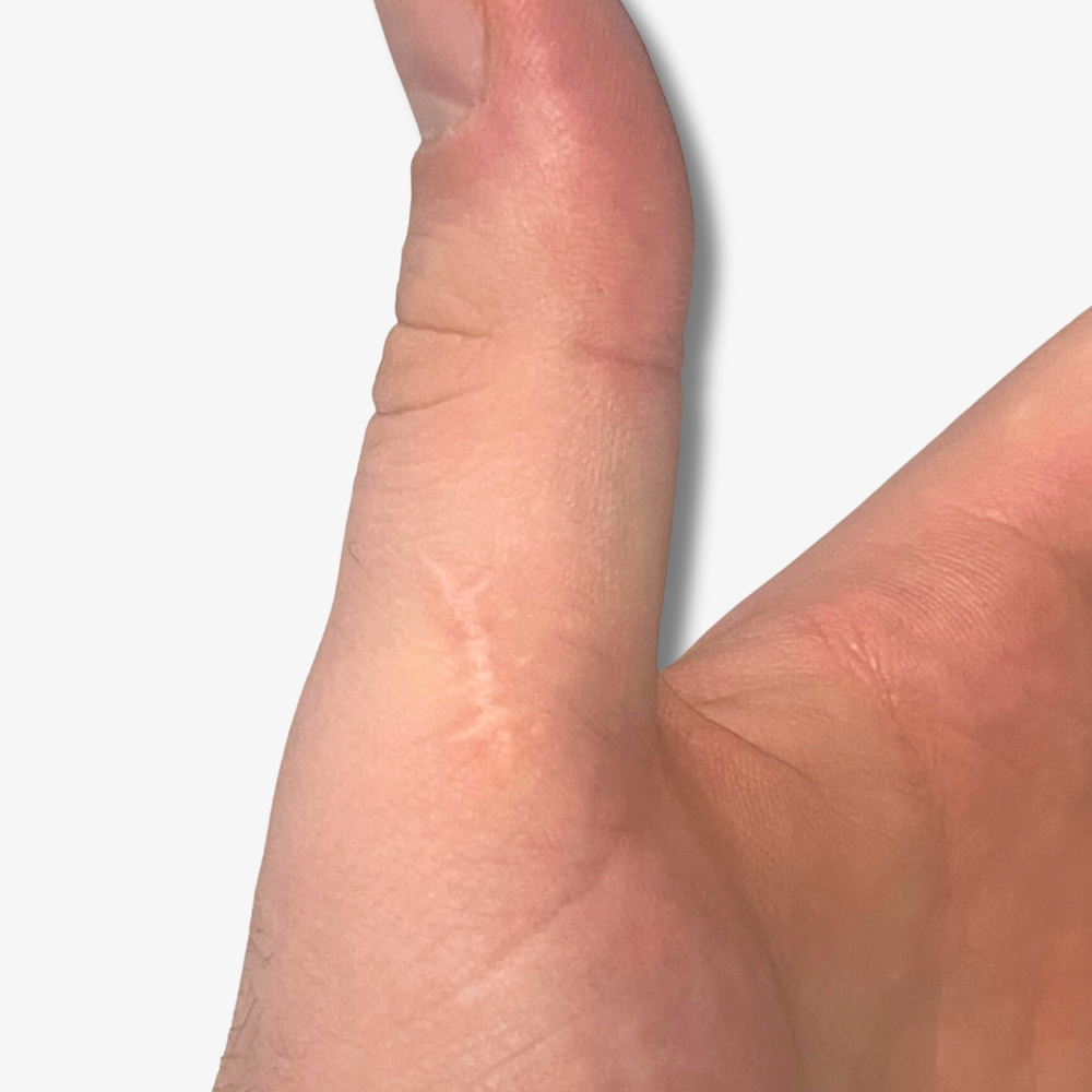 Scar Types and Causes | NewGel+